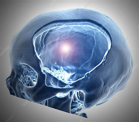 3d Ct Of Hemicraniectomy Stock Image C0365198 Science Photo Library