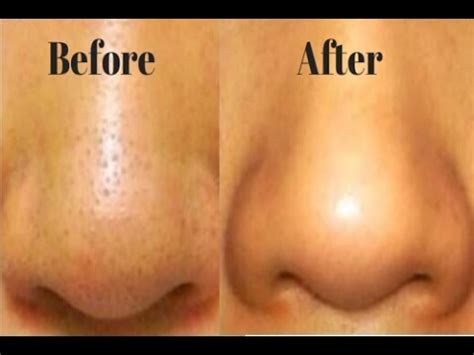Enlarged Pores Nose