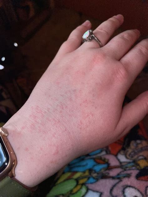 Different Psoriasis Than Normal Rpsoriasis