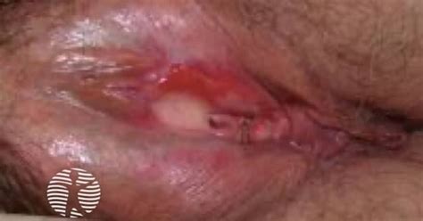 Vulval Erosive Lichen Planus Image