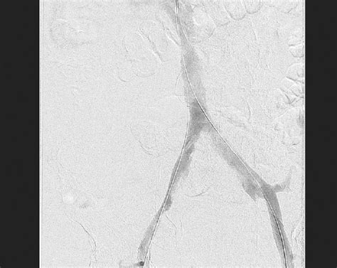 Case Report Managing The Challenges Of Extensive Thrombus Burden