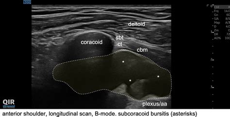 Subcoracoid Bursa