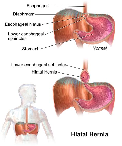 Ogden Hiatal Stomach Hernia Treatment And Repair Dr Dunning