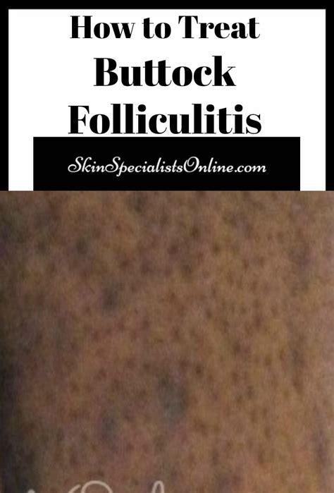 Ask A Skin Doctor Butt Acne Or Buttock Folliculitis Skin Specialists