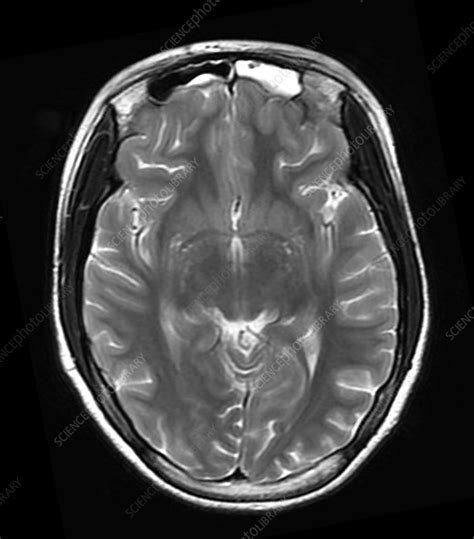 Sinusitis Complicated By Empyema Mri Stock Image C0271880