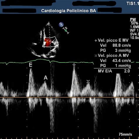Trans Mitral Us Iv Grade Diastolic Dysfunction With Ea 20 Peak Download Scientific Diagram