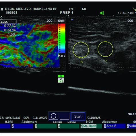 Elastography Strain Ratio Sr In Resected Surgical Bowel Specimens