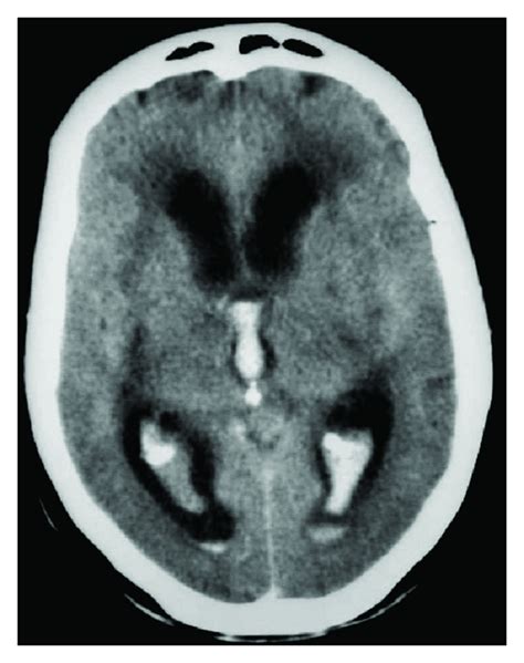 Primary Intraventricular Hemorrhagepng Neurosurgery Education Wiki