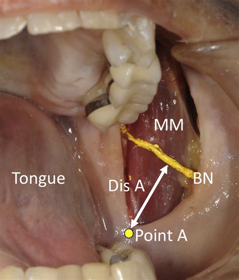 Buccal Nerve Block