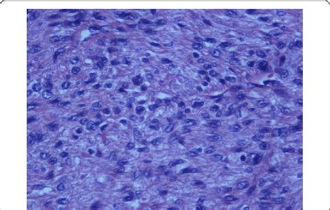 Histopathology Of Primary Pulmonary Artery Intimal Sarcoma Download Scientific Diagram