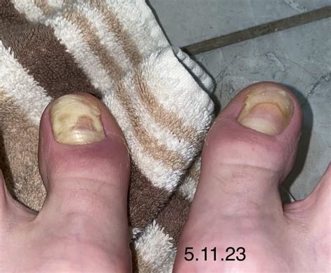 Fungus Or Something Else Ringrowntoenails