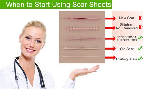 Professional Silicone Scar Sheets 1 6” X 120” Roll 3m
