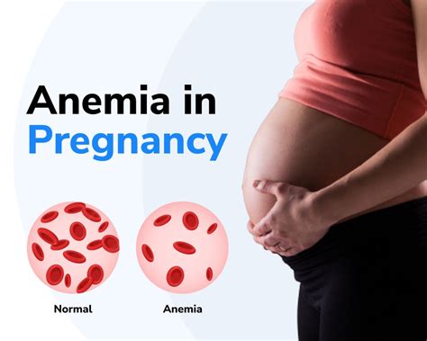 Anemia During Pregnancy And Risks Kiranmayee