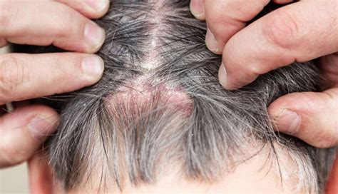 How To Treat Scabs On The Scalp Lifeberrys Com