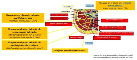 Bloqueo En El Plano Del Músculo Semiespinoso De La Cabeza Ccap Cervical Semispinalis Capitis