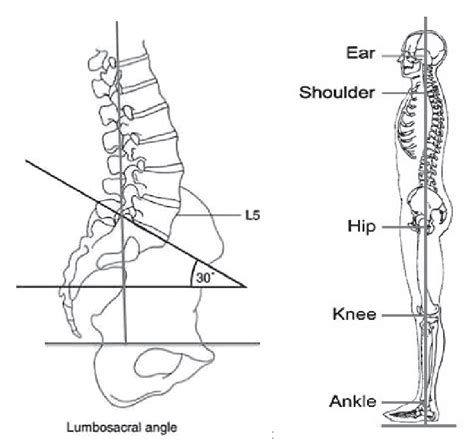 A Notch Acetabular Line And Notch Acetabular Angle Sacroacetabular