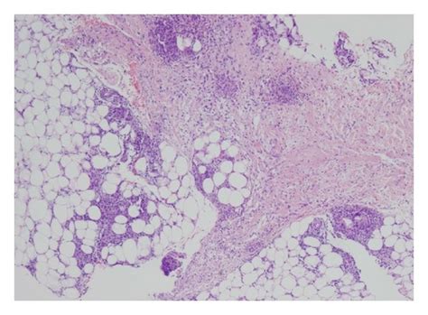 A Normal Epidermis And Dermis Inflammatory Infiltrate Affecting Download Scientific Diagram