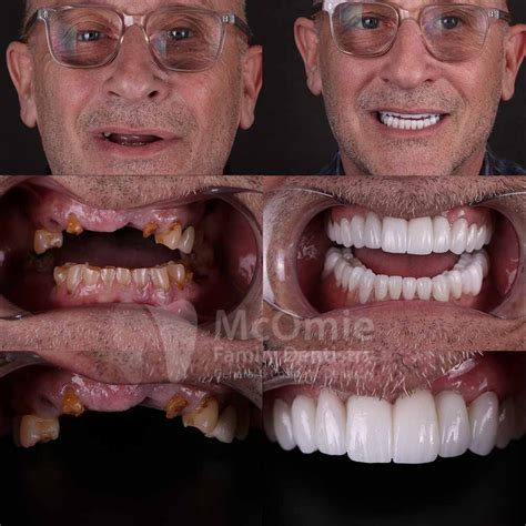 Options For Full Mouth Reconstruction Mcomie Dentistry Chattanooga