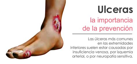 Úlceras La Importancia De La Prevención