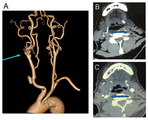 Hyoid Bone Injury