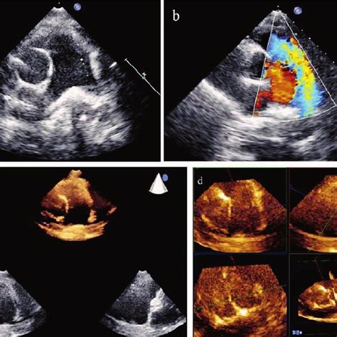 Echocardiography Views A 2d Echo Short Axis Showing Markedly Dilated