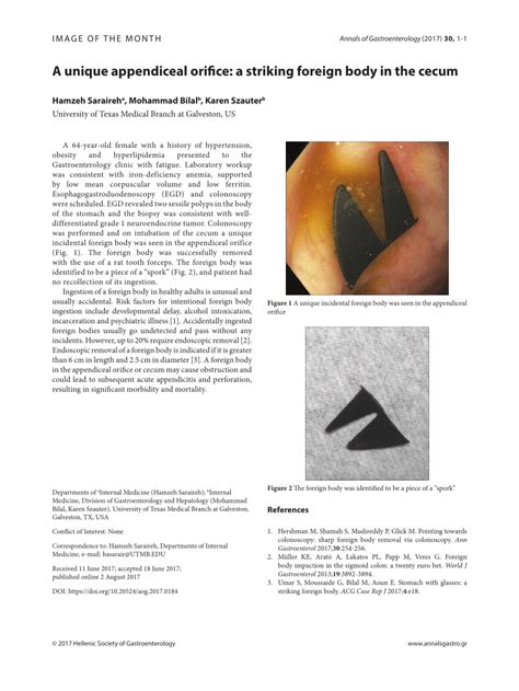 Pdf A Unique Appendiceal Orifice A Striking Foreign Body In The Cecum