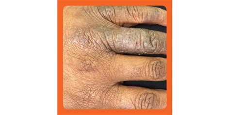 What Eczema On Black Skin Looks Like According To Dermatologists