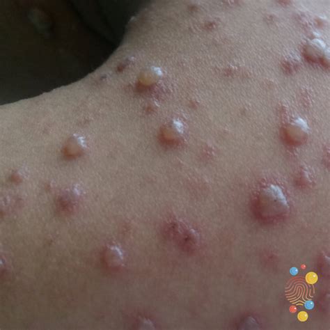 Chicken Pox Skin Deep