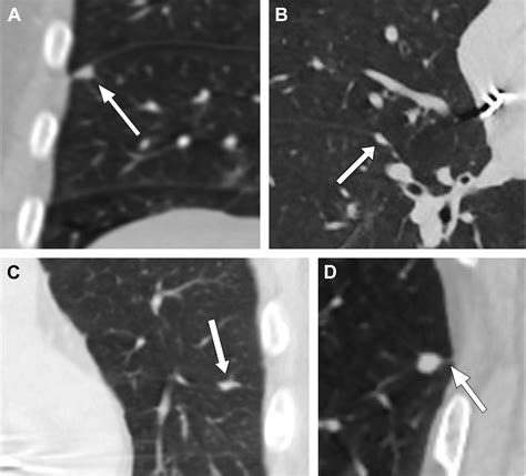 Lymphatic Drainage Of Thoracic And Extrathoracic Malignancies