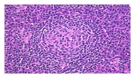 Axillary Lymph Node Biopsy Showing Plasma Cell Proliferation In The