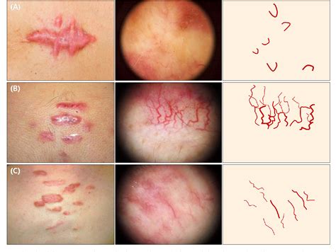 What Are Hypertrophic Scars At Carlos Snyder Blog
