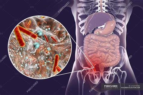 Illustration Of Red And Inflamed Human Appendix And Close Up Of Bacteria Causative Agents Of