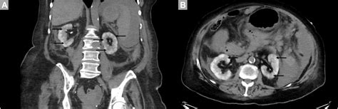 Clinical Implications Of Striated Nephrogram In Patients Receiving