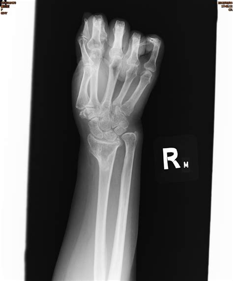 Ulnar Variance Hand Orthobullets