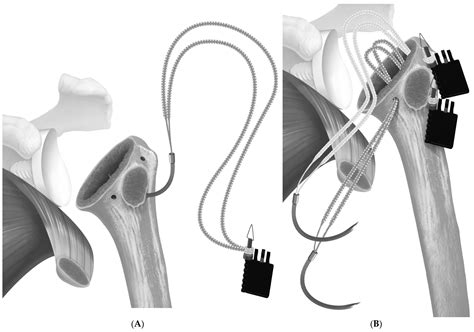 Jcm Free Full Text Lesser Tuberosity Osteotomy Healing In Stemmed
