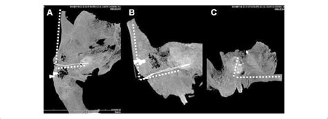 Trajectory Angle Measurements On Postoperative Computed Tomographic Download Scientific Diagram