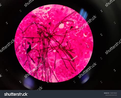 Septate Hyphae Tracheal Aspirate Sample Gram Foto Stok 1728570934