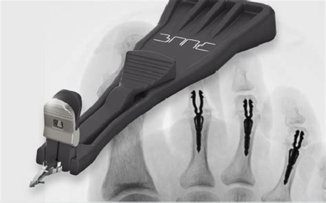 A Closer Look At A New Nitinol Hammertoe Implant