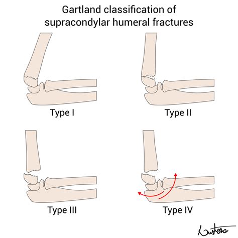 Radiopaedia Case Gartland Classification Of Supracondylar Humeral