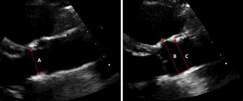 Normal Values Of Aortic Root Size According To Age Sex And Race