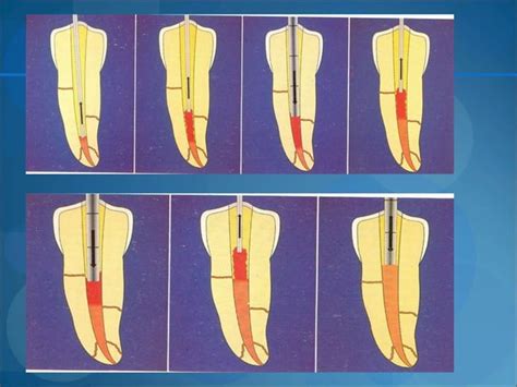 Obturation Techniquesppt