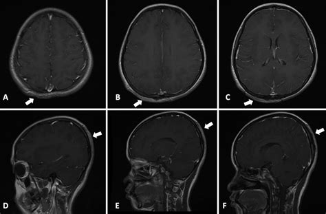 The Recurrent Plexiform Neurofibroma Of The Scalp In Neurofibromatosis Type 1 Illustrative Case