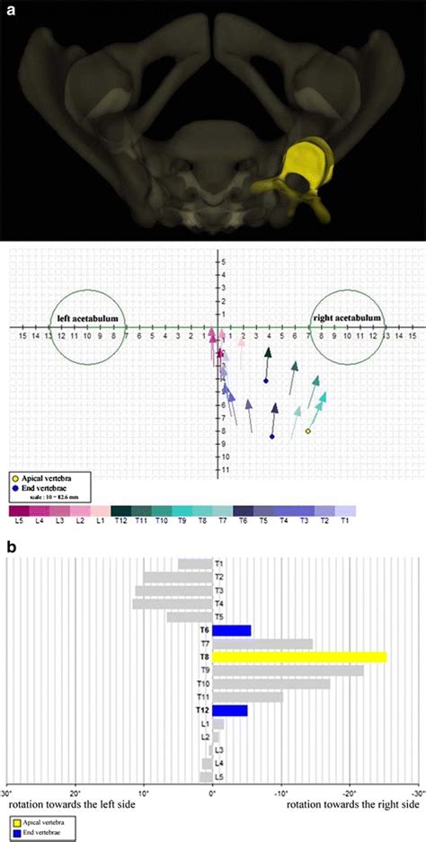 3 Axial Vertebral Rotation Assessed By The Eos Method This 3d Method
