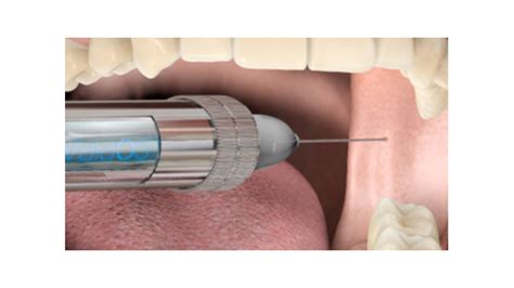 Infiltration And Nerve Block Anaesthesia