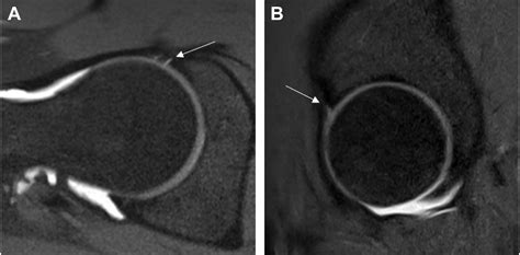 Update On Mr Imaging Of The Acetabular Labrum Magnetic Resonance