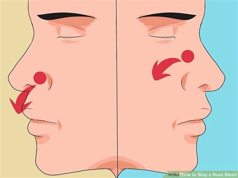 3 Ways To Stop A Nose Bleed WikiHow