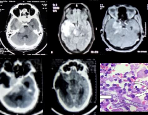 A 38 Year Old Male Patient Presented With A Non Specific Headache With