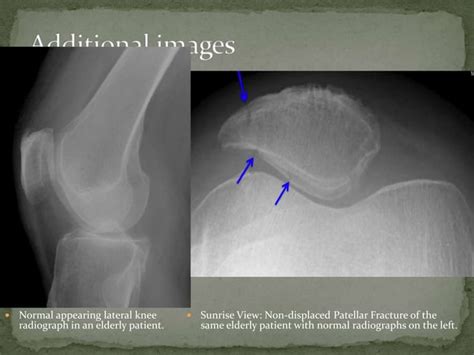 Patellar Fracture Ppt