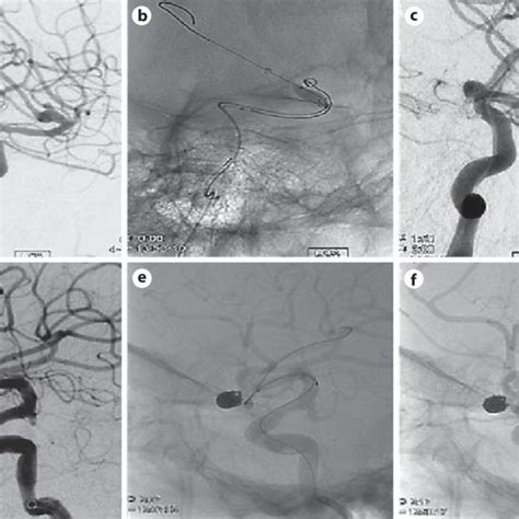 A Image Of A Left Mca Aneurysm Before Embolization B Image Showing Download Scientific Diagram