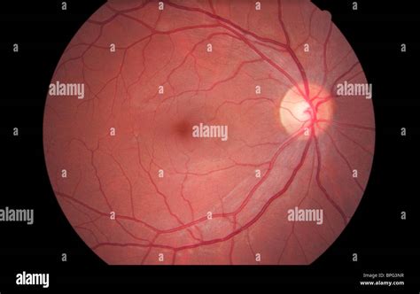 Contact Lenses Veins In The Eyes At Gemma Dalton Blog
